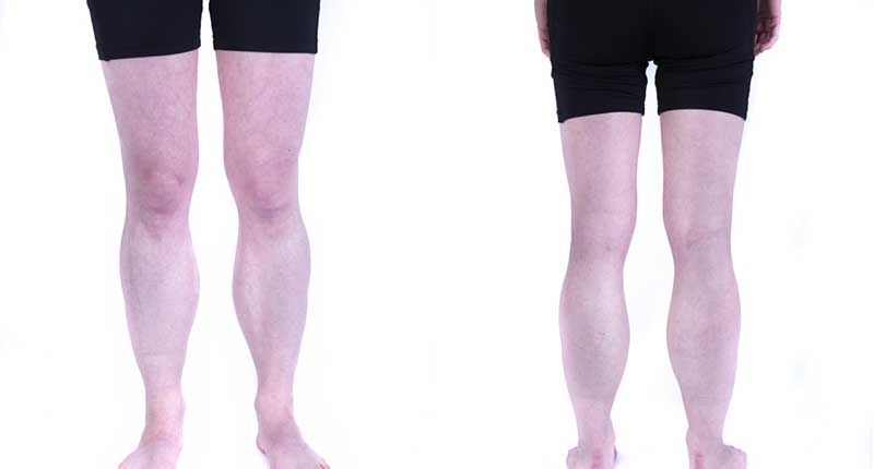 Living with Lipodystrophy | Becky Smith | Lipodystrophy UK